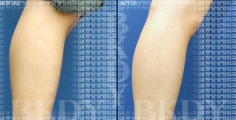 BK Plastic Surgery: BK Plastic Surgery Hospital's Calf Reduction Surgery